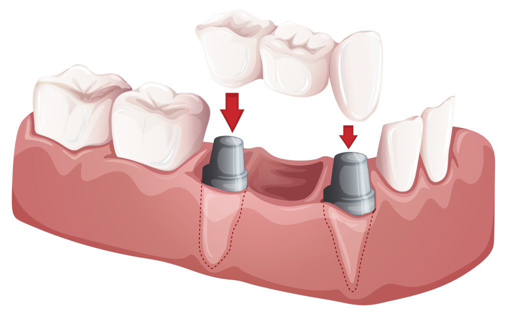 Implantati i zubne proteze | Dental centar Miletić | vratite osmijeh